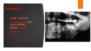 calcifying epithelial odontogenic tumor Ceot | PPTX