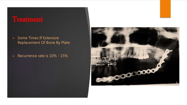 calcifying epithelial odontogenic tumor Ceot | PPT