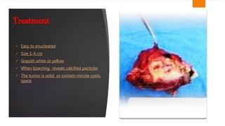 calcifying epithelial odontogenic tumor Ceot | PPTX
