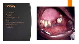 calcifying epithelial odontogenic tumor Ceot | PPTX
