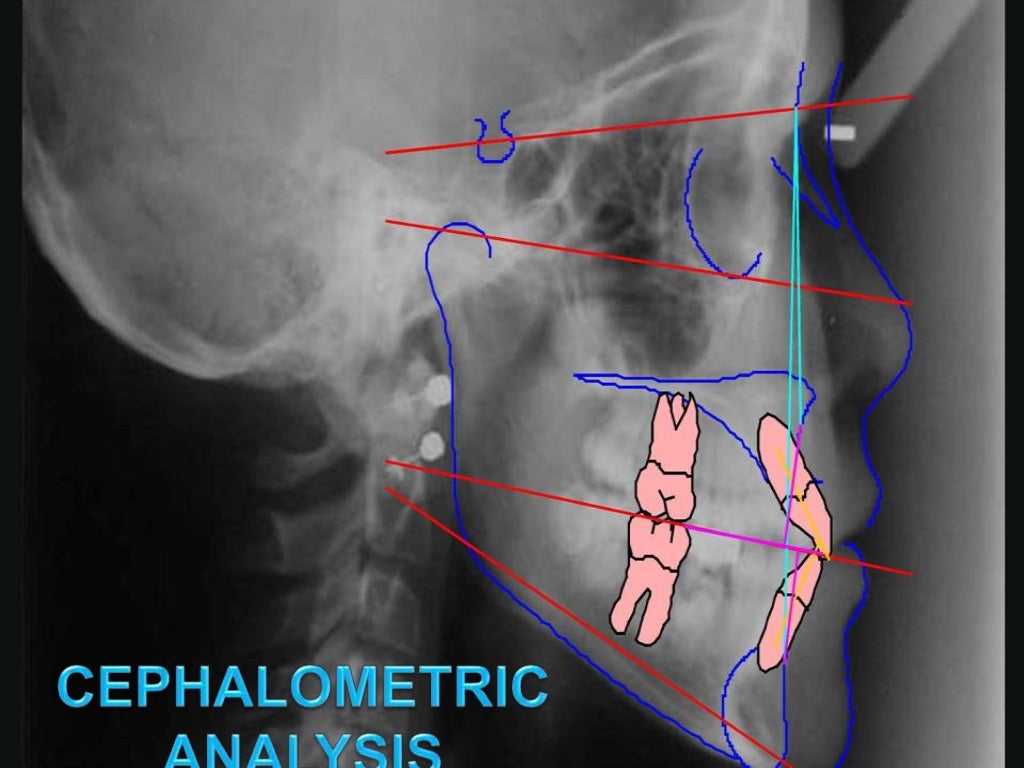 Cephalometric Analysis