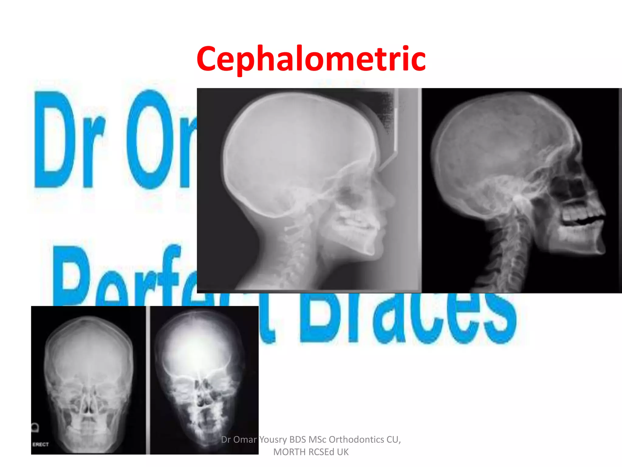 lateral Cephalometry | PPTX