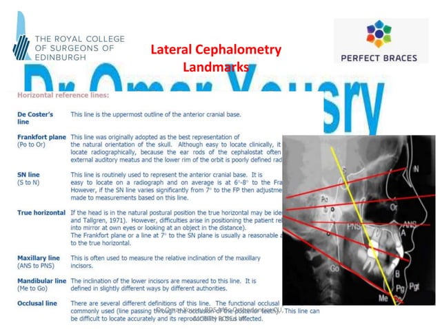 lateral Cephalometry | PPTX