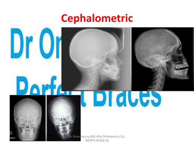 lateral Cephalometry | PPTX