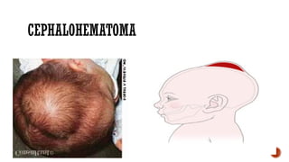 Cephalohematoma and its causes in detail.pptx