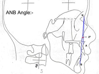Cephalometric analysis | PPT
