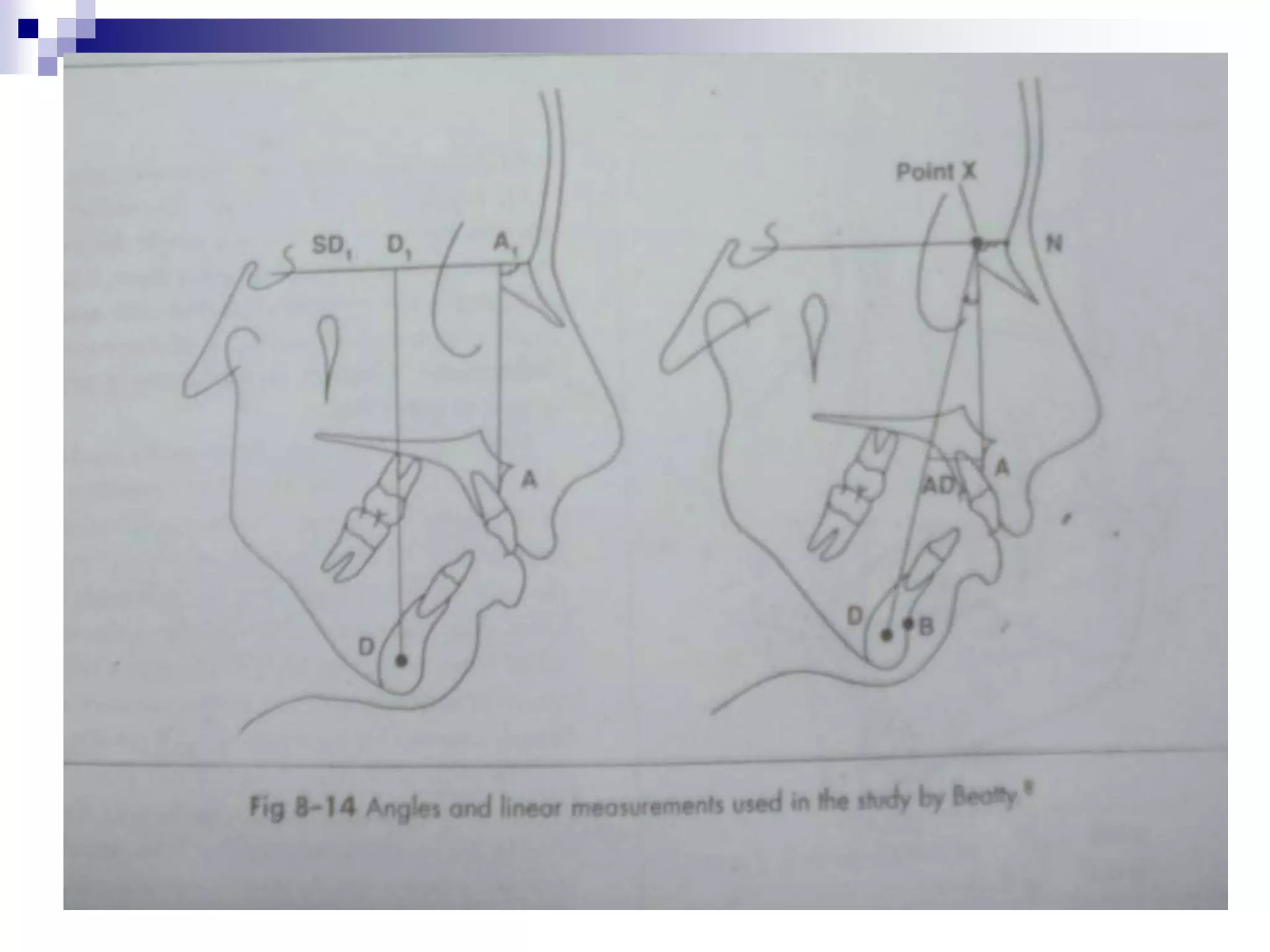 CEPHALOMETRIC ANALYSIS.ppt
