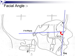 CEPHALOMETRIC ANALYSIS.ppt