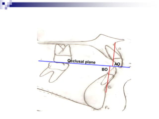 CEPHALOMETRIC ANALYSIS.ppt