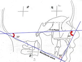 CEPHALOMETRIC ANALYSIS.ppt