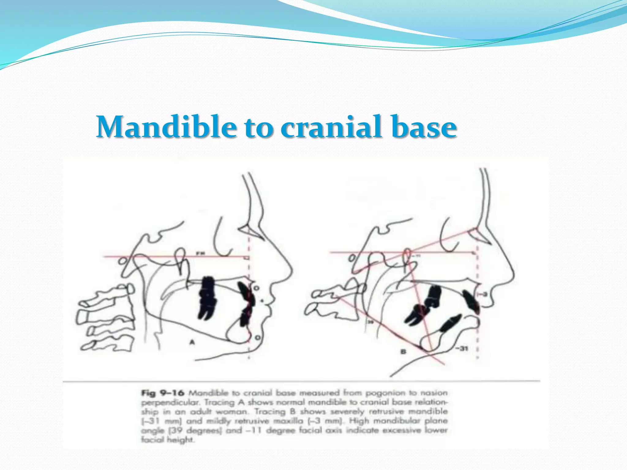 Orthodontic Cephalometric analysis | PPTX