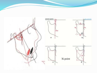 Orthodontic Cephalometric analysis | PPTX