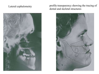 Cephalometric analysis natarajan | PPT