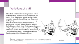 Cephalometric Analysis of discrepancy in Vertical plane | PPTX