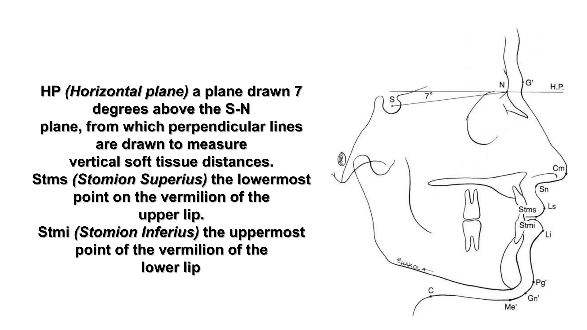 Cephalometric for orthognathic surgery part 1 | PPTX