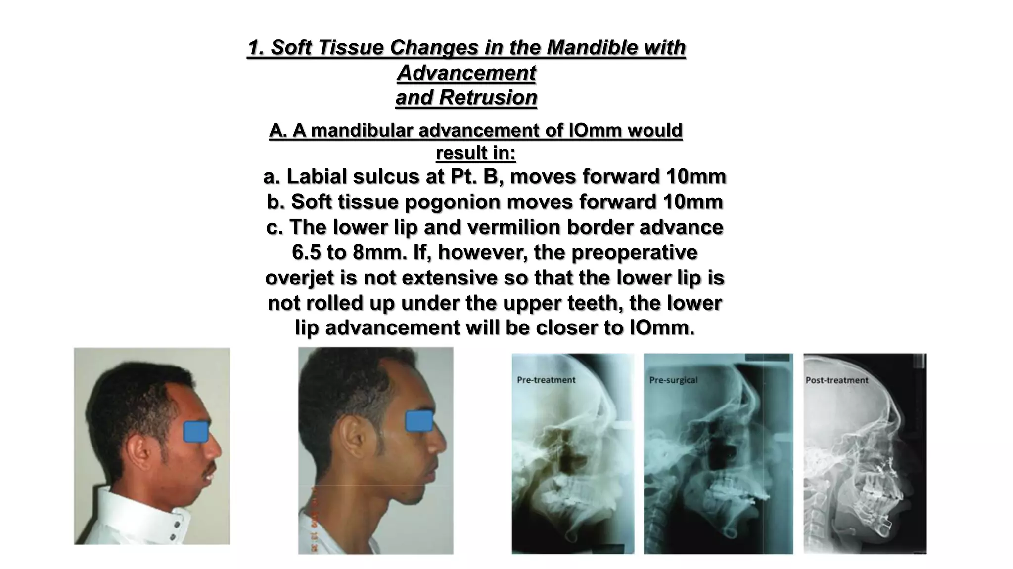 Cephalometric for orthognathic surgery part 1 | PPTX