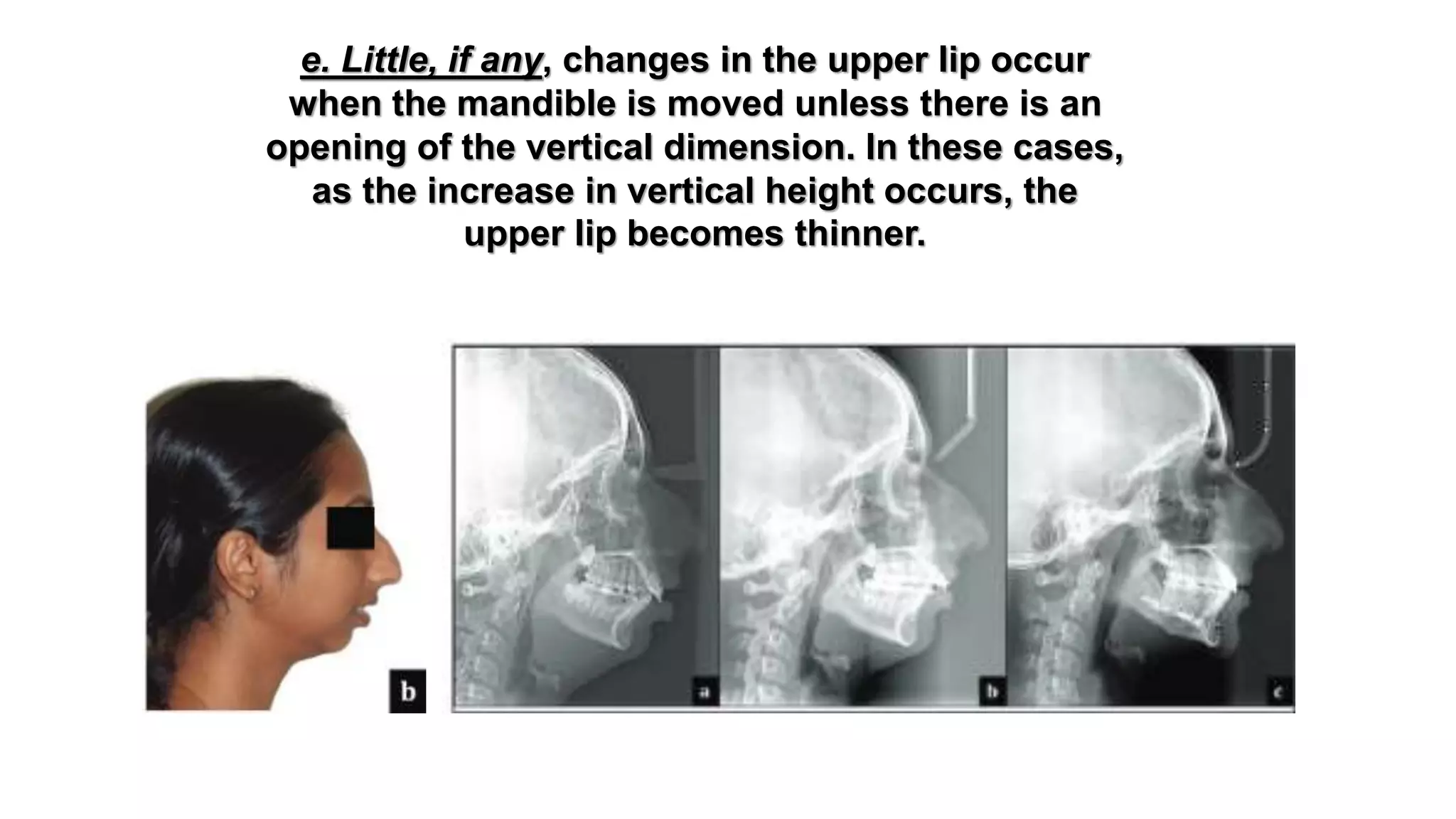 Cephalometric for orthognathic surgery part 1 | PPTX