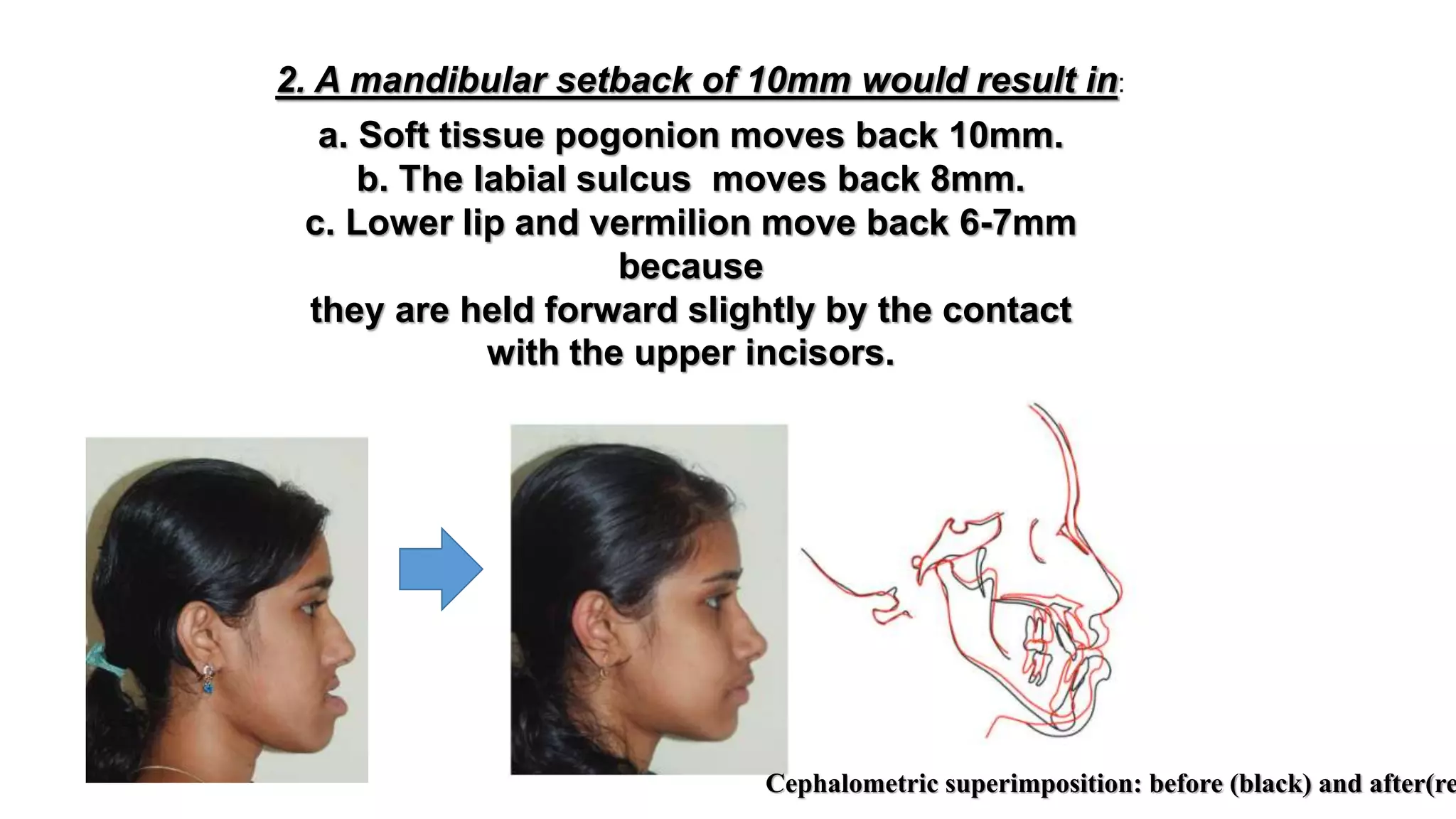 Cephalometric for orthognathic surgery part 1 | PPTX