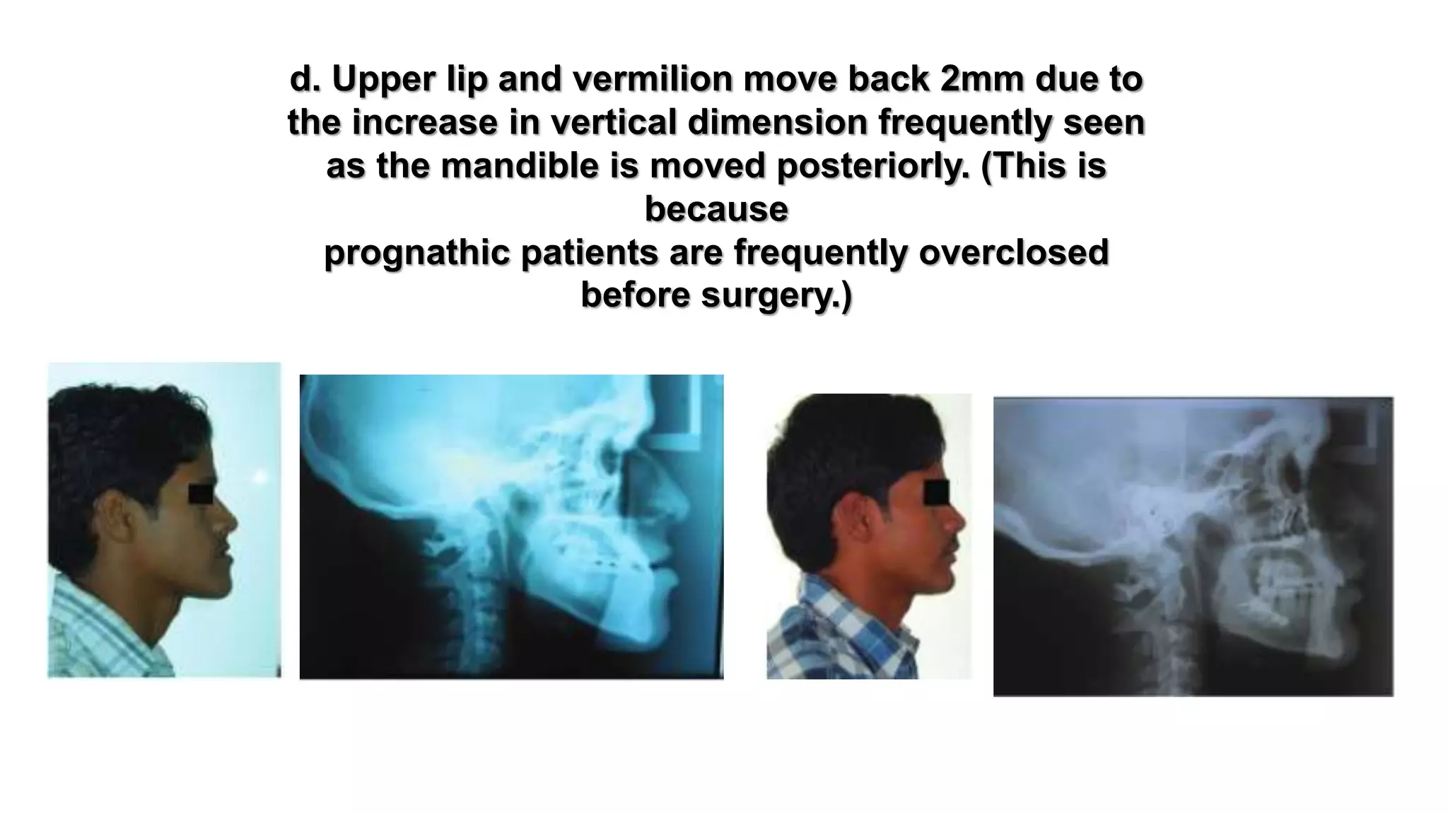 Cephalometric for orthognathic surgery part 1 | PPTX