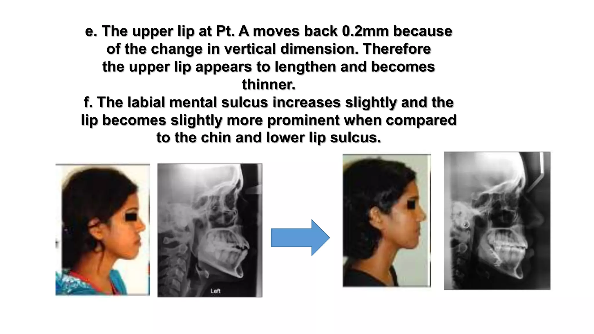Cephalometric for orthognathic surgery part 1 | PPTX
