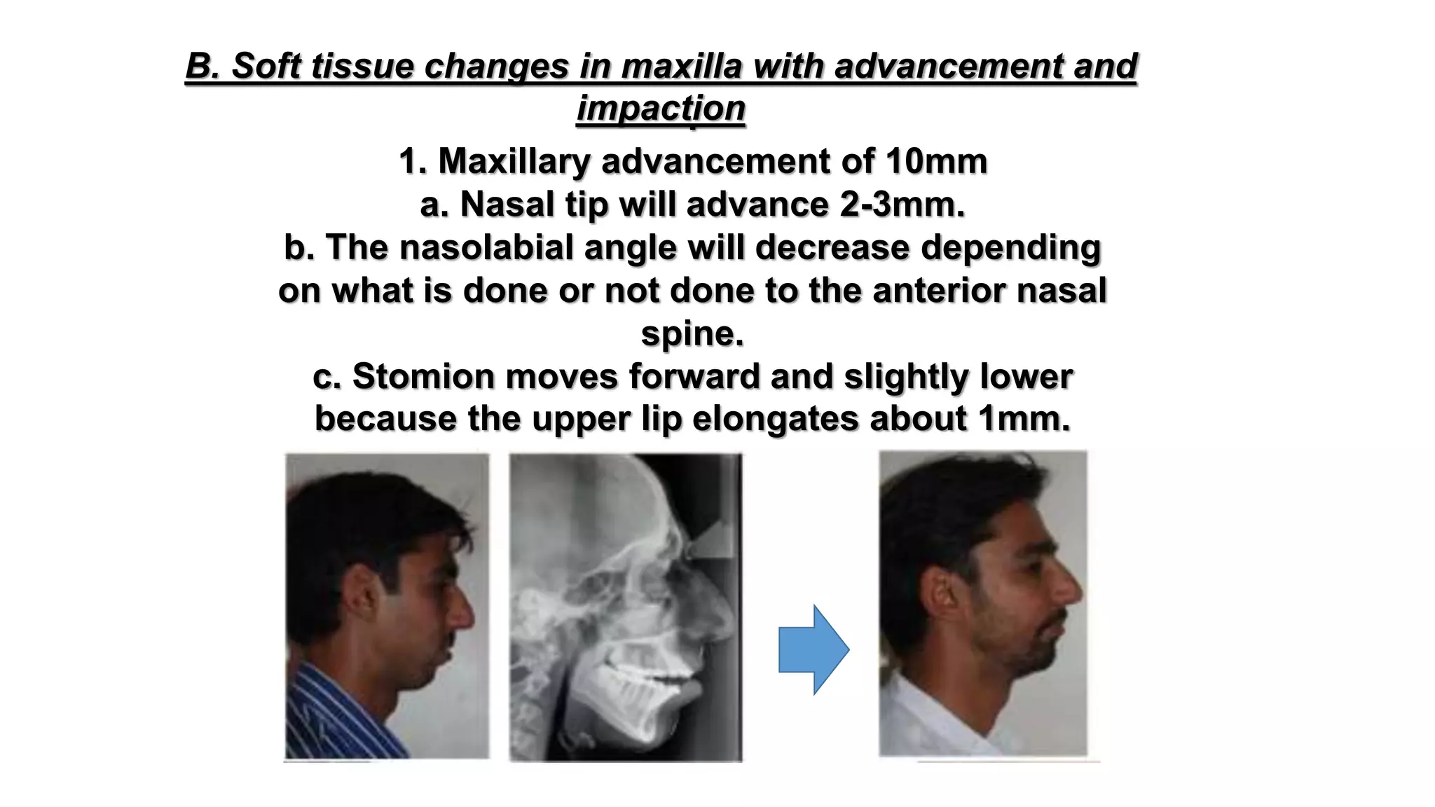 Cephalometric for orthognathic surgery part 1 | PPTX