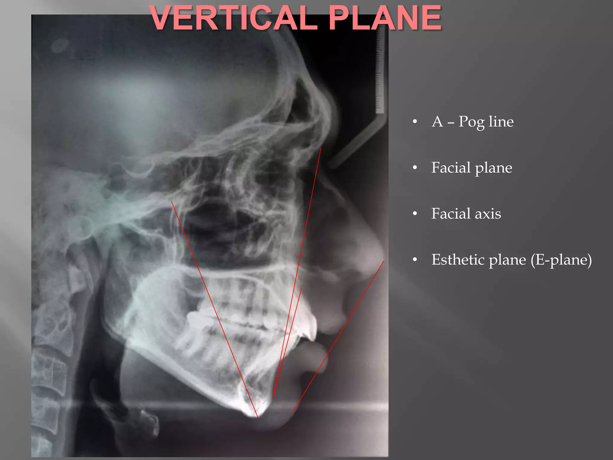 Cephalometric landmarks | PPTX