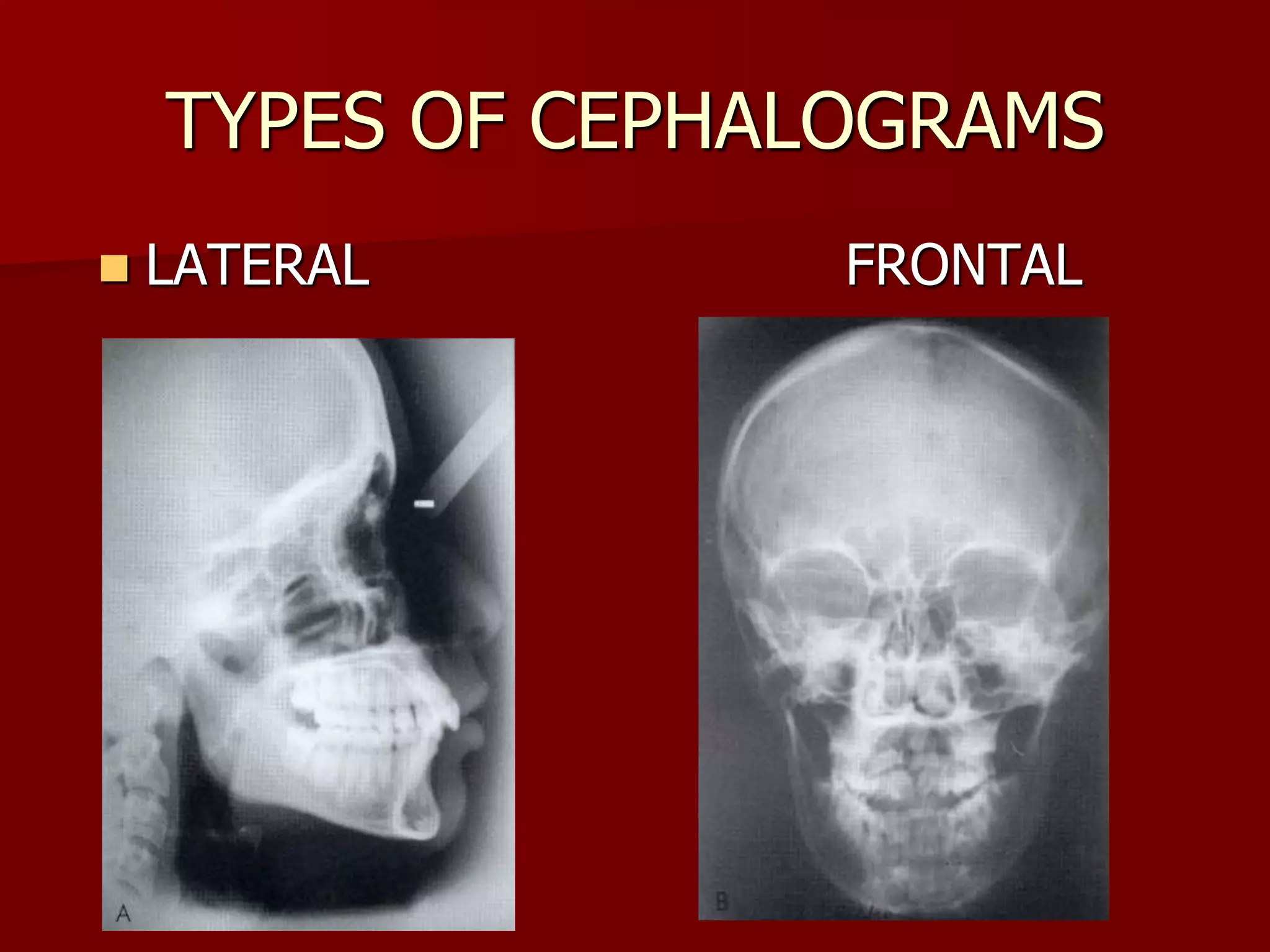 Cephalometric landmarks | PPT