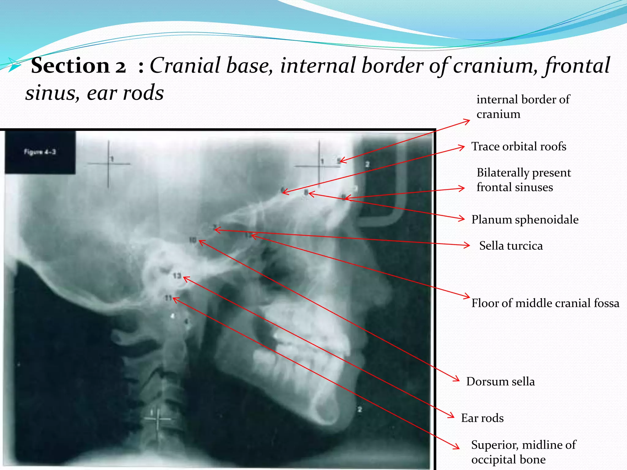 Cephalometrics | PPTX