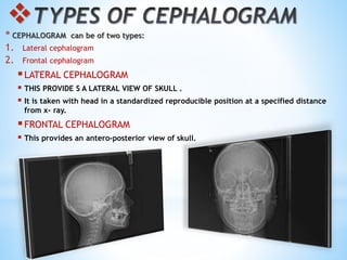 Cephalometrics | PPTX