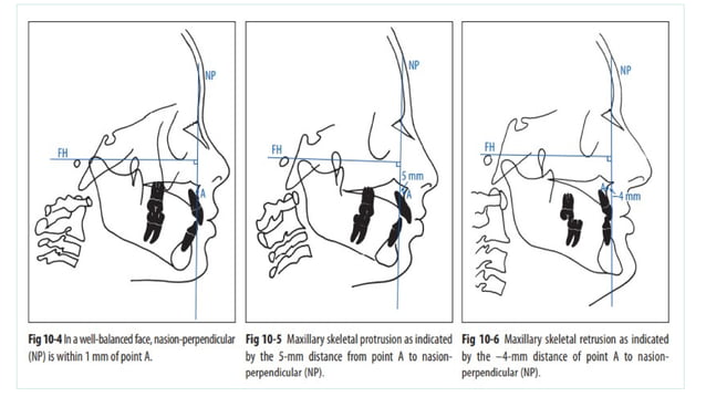 Cephalometrics analysis in orthodontics.pptx