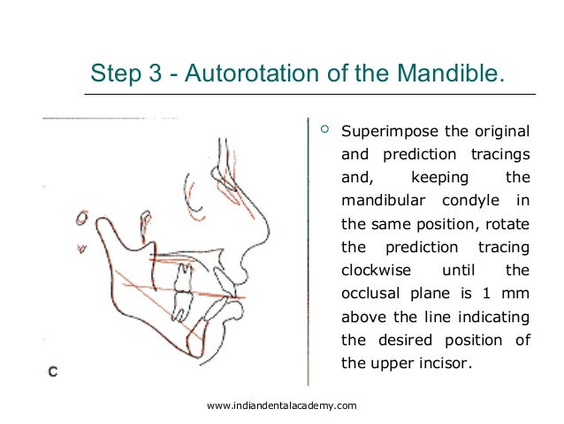 Cephalometrics for orthognathic surgery1 /certified fixed orthodontic…
