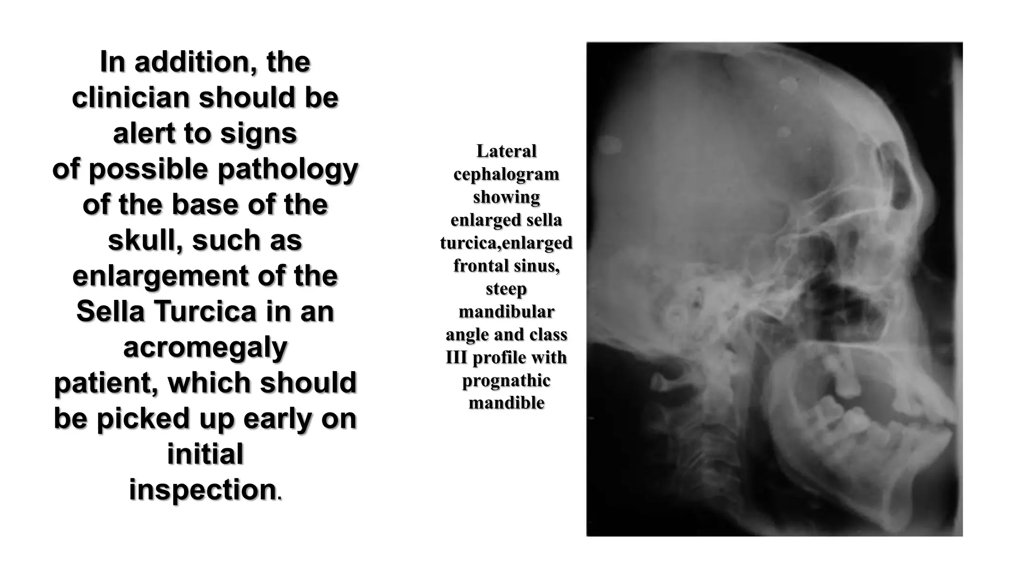 Cephalometrics for orthognathic surgery part 2 | PPTX