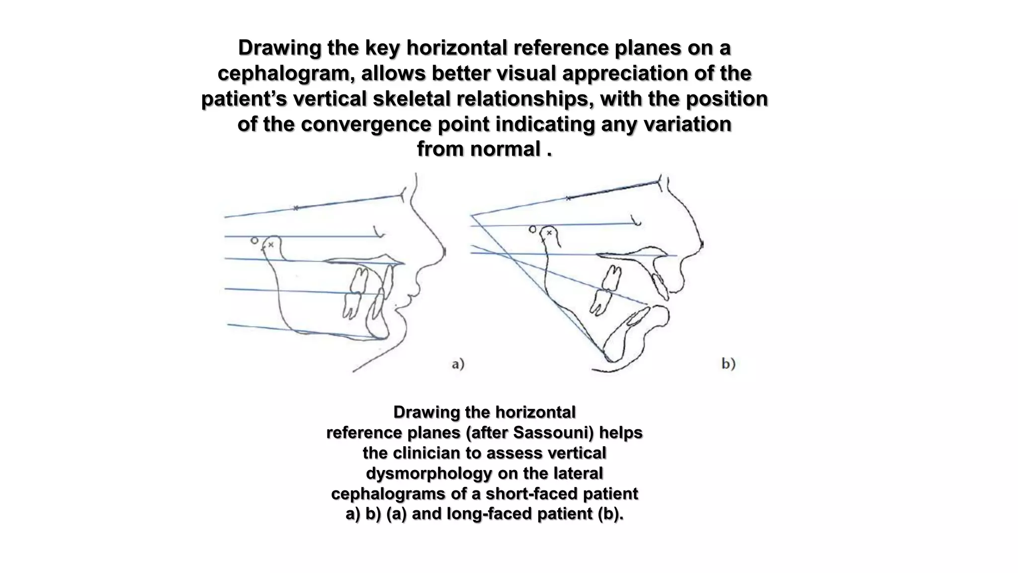 Cephalometrics for orthognathic surgery part 2 | PPTX