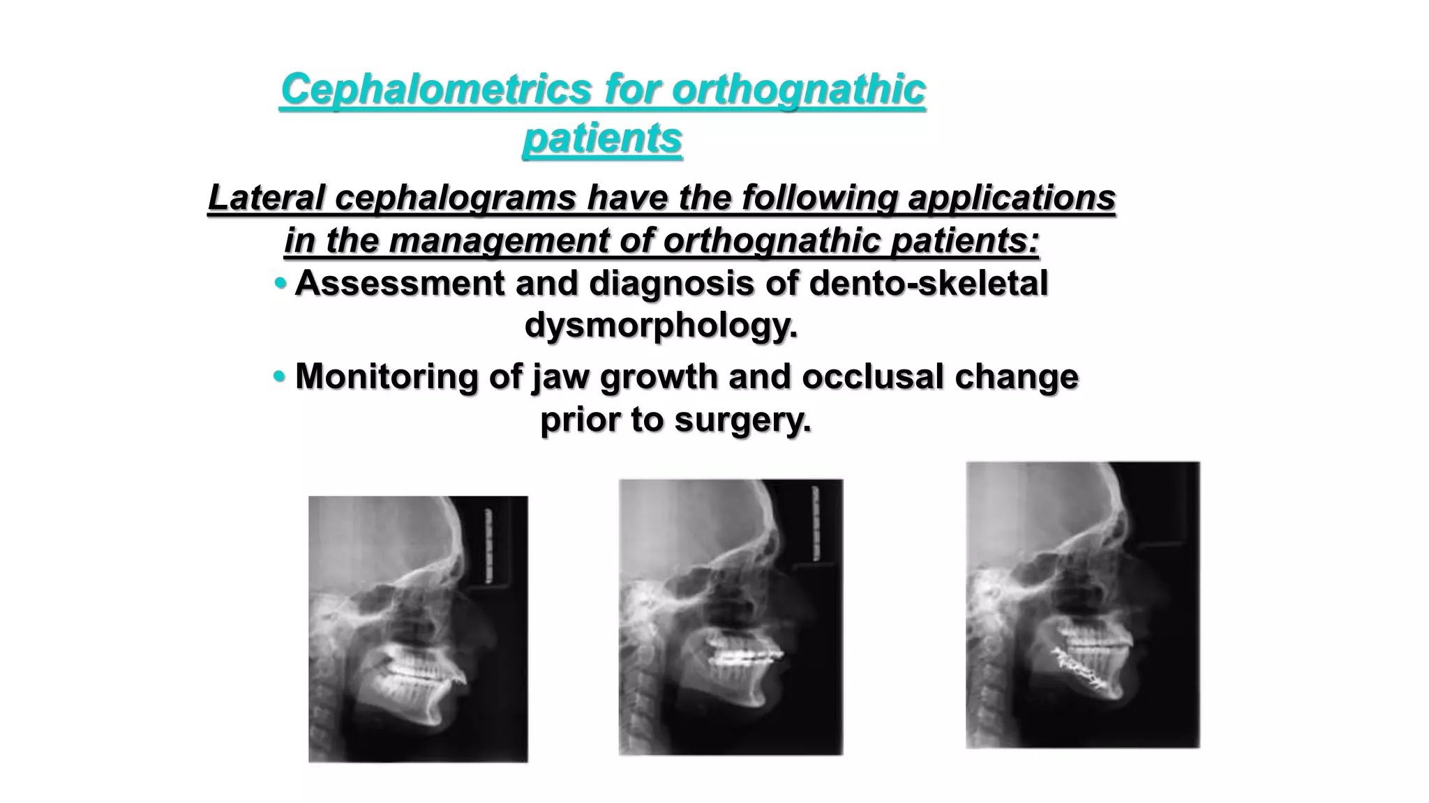Cephalometrics for orthognathic surgery part 2 | PPTX