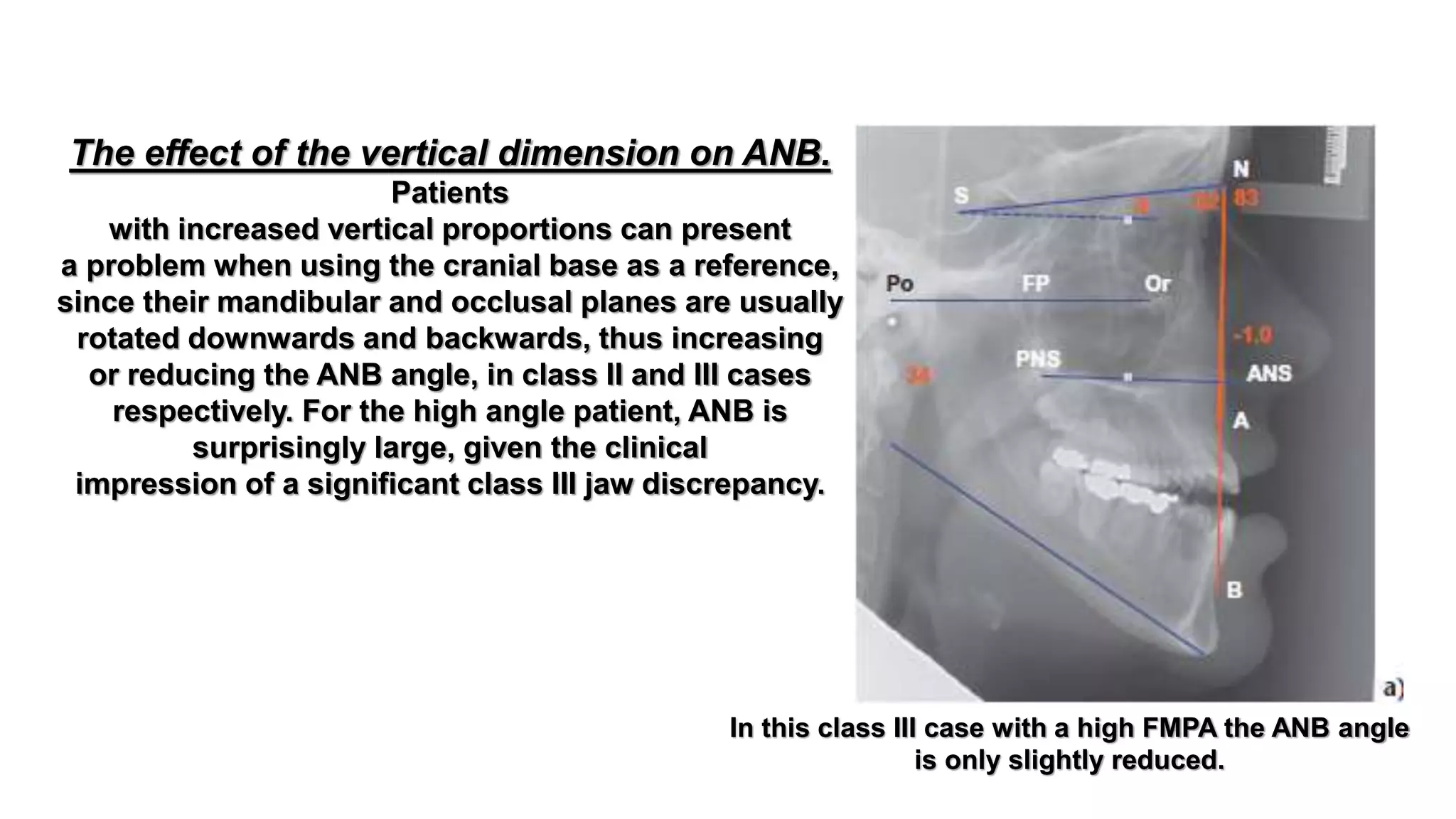 Cephalometrics for orthognathic surgery part 2 | PPTX