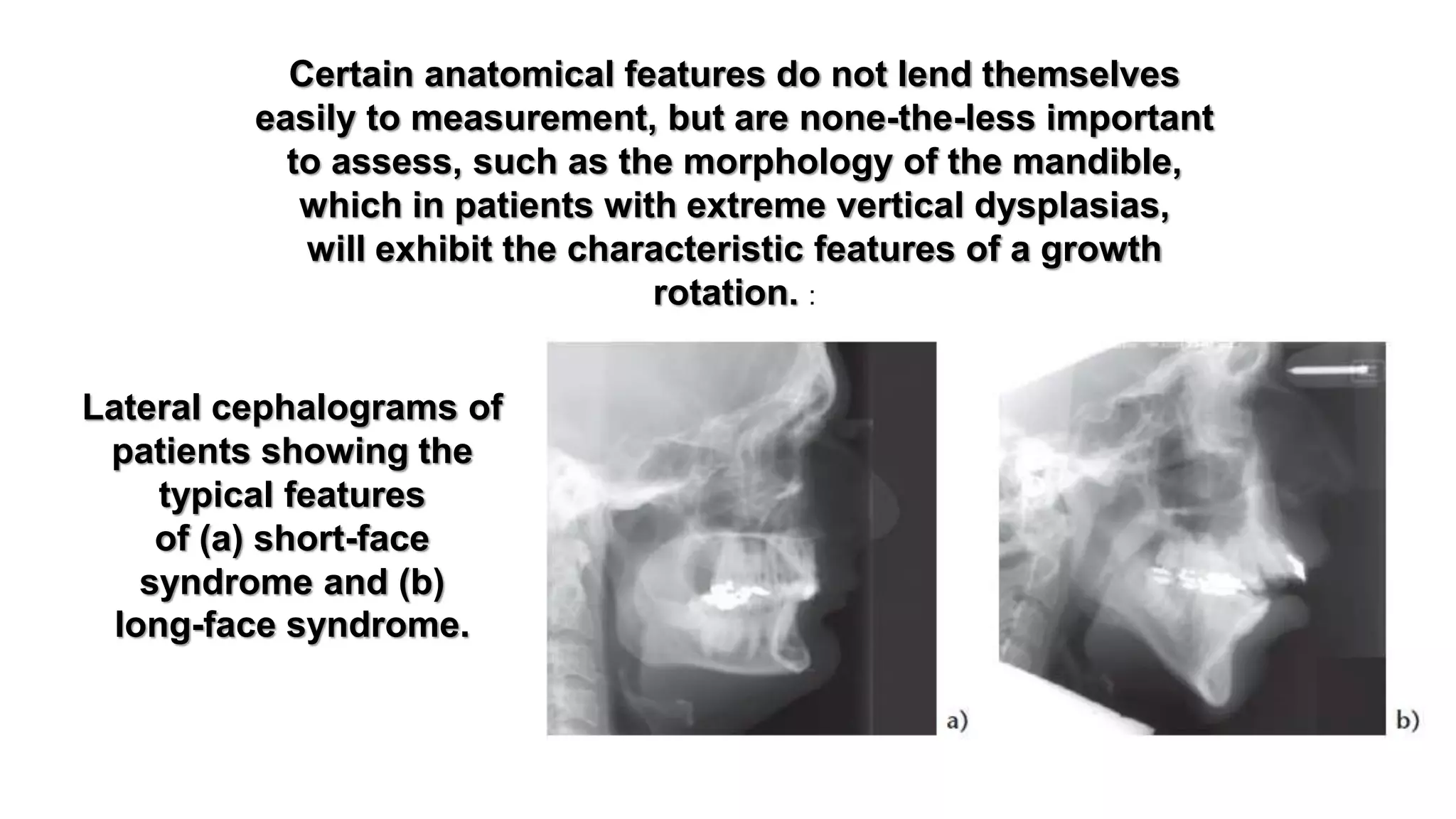 Cephalometrics for orthognathic surgery part 2 | PPTX