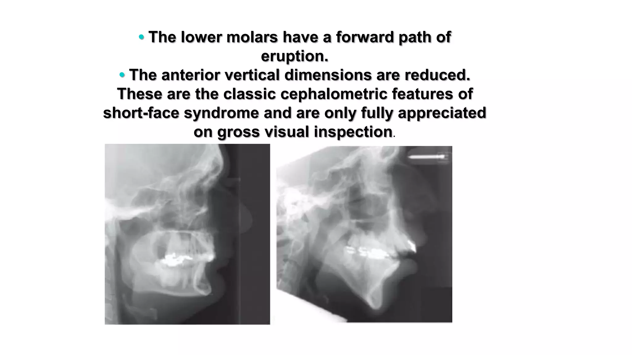 Cephalometrics for orthognathic surgery part 2 | PPTX