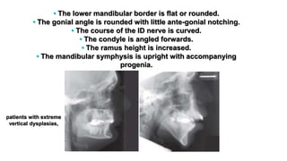 Cephalometrics for orthognathic surgery part 2 | PPTX