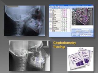 Cephalometrics in orthodontics | PPTX