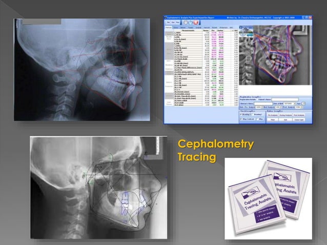 Cephalometrics in orthodontics | PPTX | Dental Health | Diseases and ...