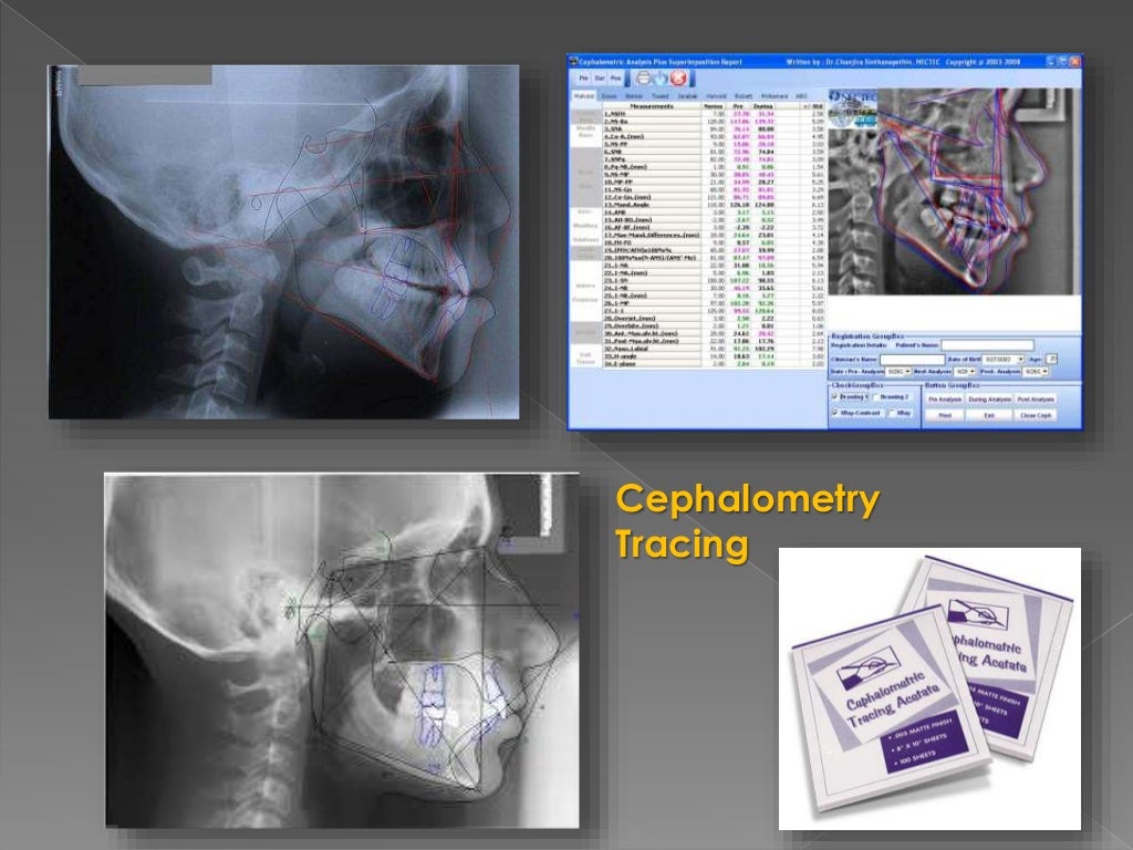 Cephalometrics in orthodontics