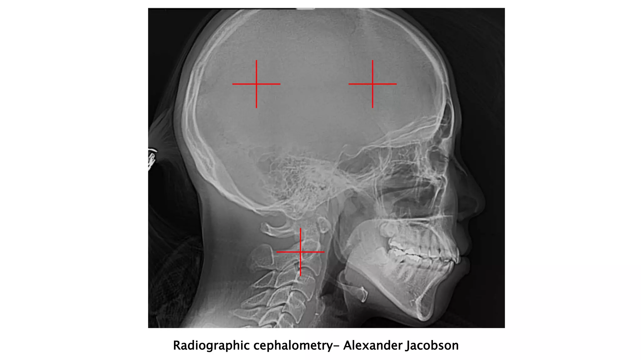 Cephalometrics analysis | PPTX | Dental Health | Diseases and Conditions