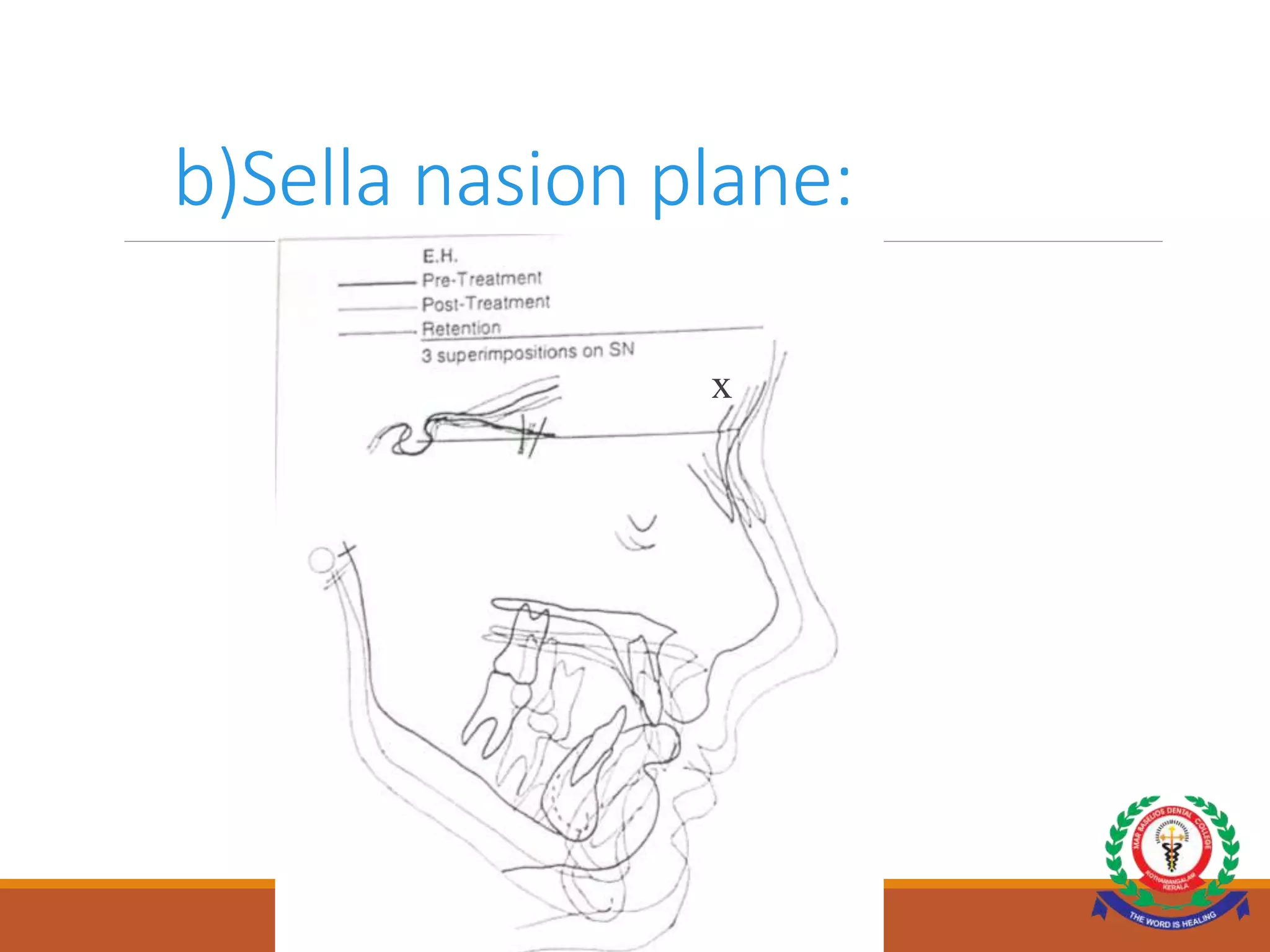 CEPHALOMETRIC SUPERIMPOSITION.ppt