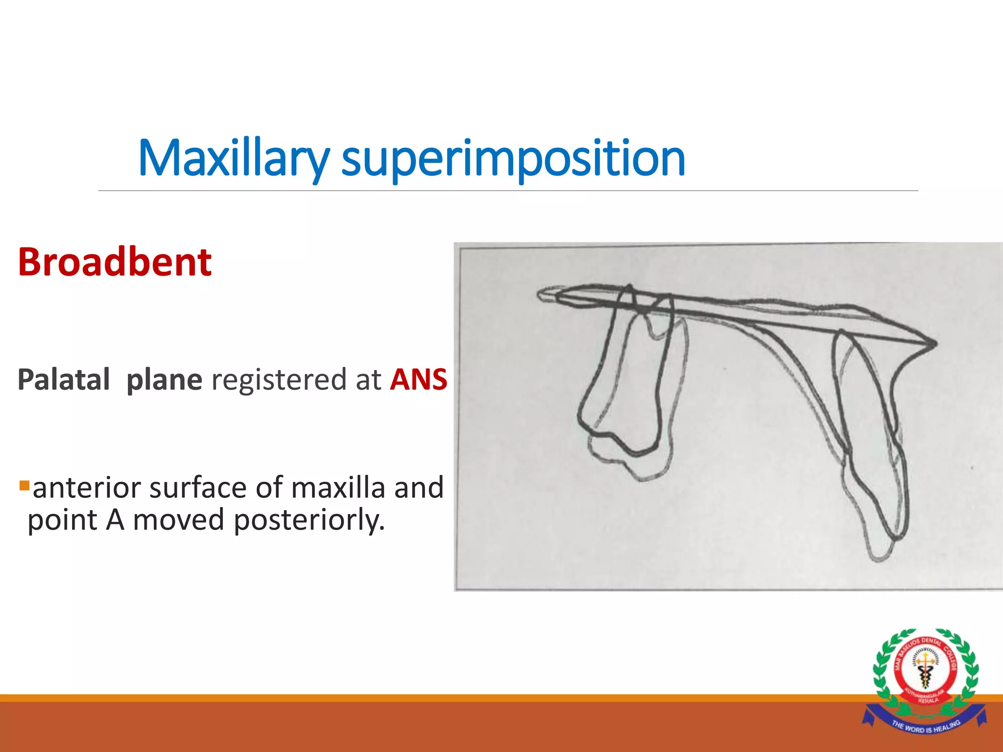 CEPHALOMETRIC SUPERIMPOSITION.ppt