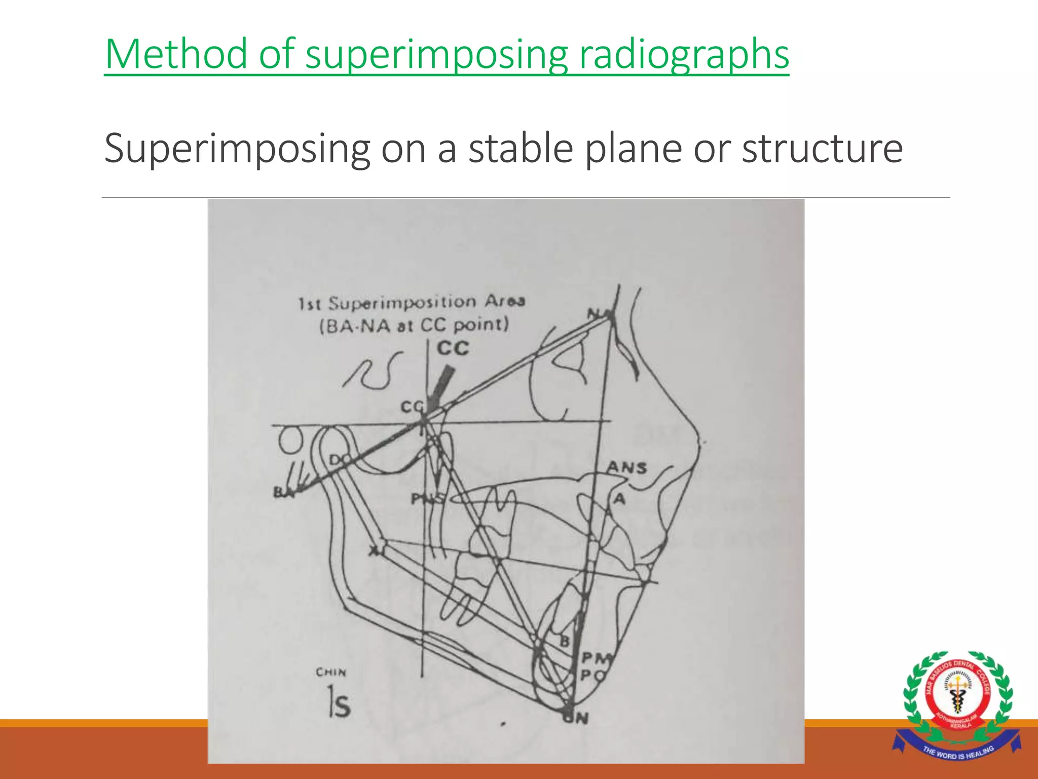 CEPHALOMETRIC SUPERIMPOSITION.ppt