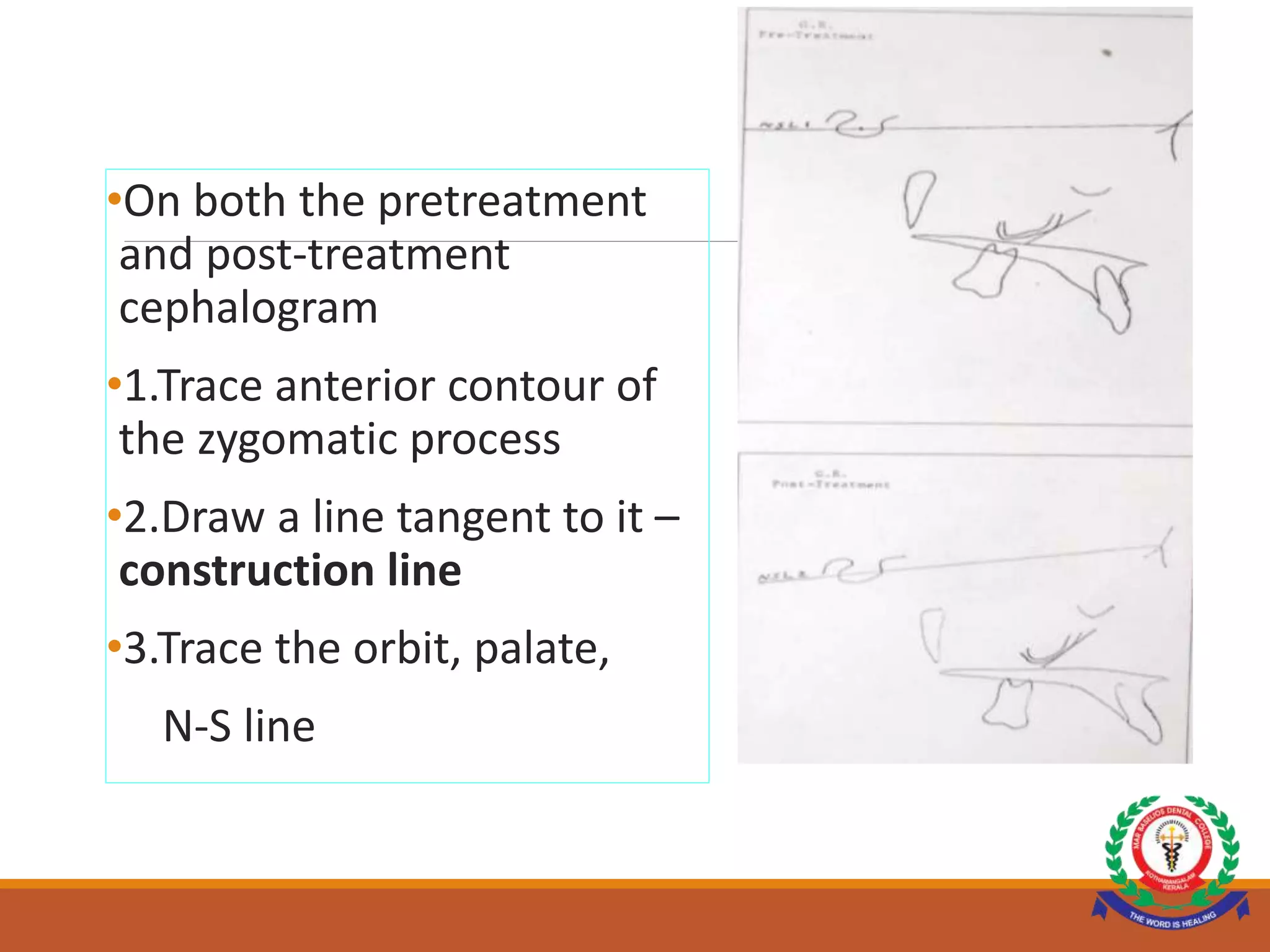 CEPHALOMETRIC SUPERIMPOSITION.ppt