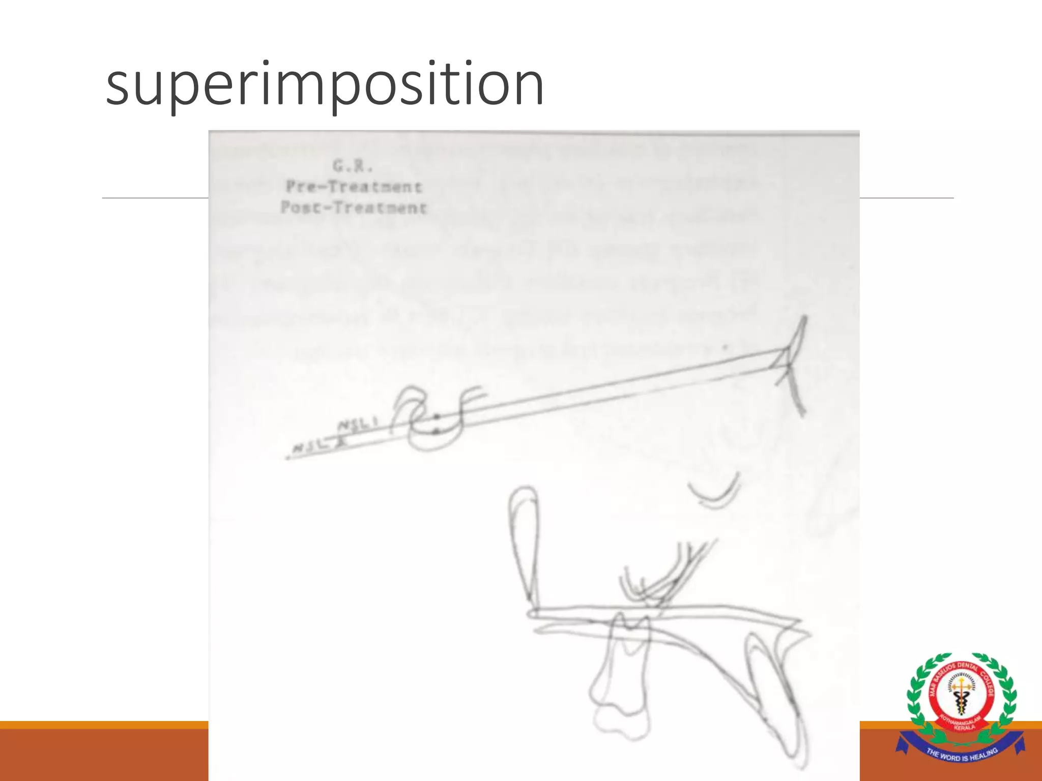 CEPHALOMETRIC SUPERIMPOSITION.ppt