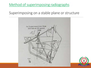 CEPHALOMETRIC SUPERIMPOSITION.ppt
