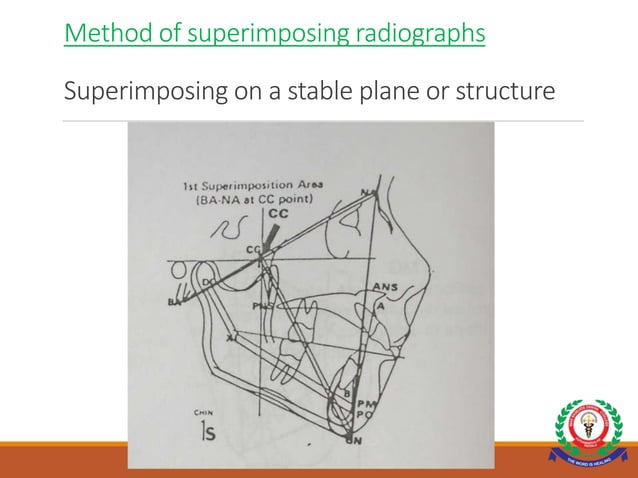 CEPHALOMETRIC SUPERIMPOSITION.ppt | Dental Health | Diseases and Conditions