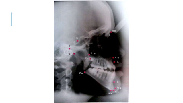 Cephalometry 1 | PPT
